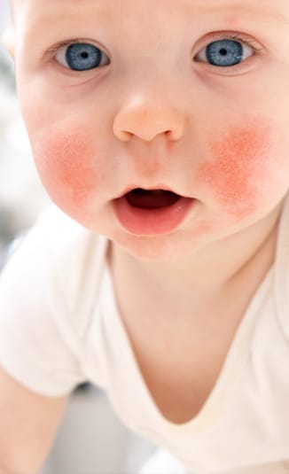 Ekcem kod beba i dece - Drugačiji Pristup